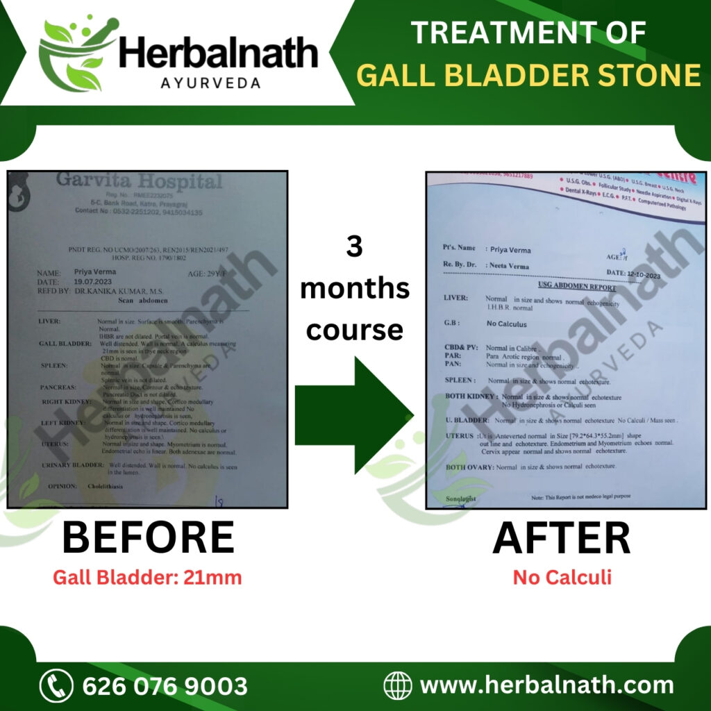Gall Bladder Patient Review – Herbal Nath Ayurveda